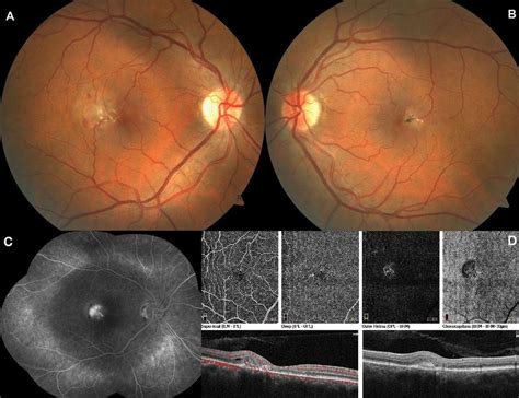 Macular Telangiectasia Type 2 Complicated With Choroidal Neovascularization Retinara