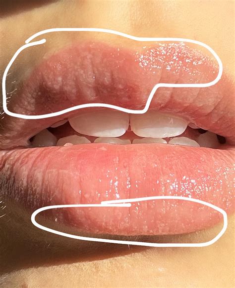 Small Bumps On Lips Itchy