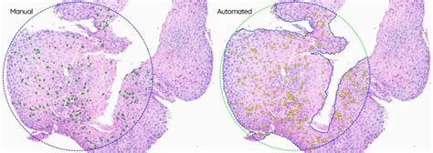 Scoring Eosinophilic Esophagitis Eoe In Clinical Trials Is No Small