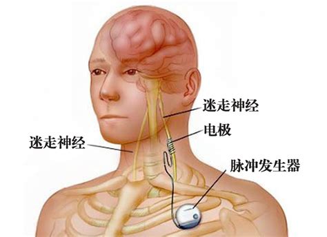 迷走神经刺激术（vns） 哈尔滨医科大学附属第二医院