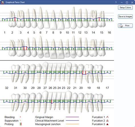 Open Dental Software Graphical Perio Chart