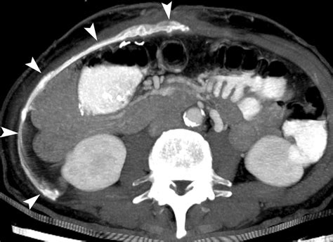 Abdominal Wall Hernias Imaging Features Complications And Diagnostic