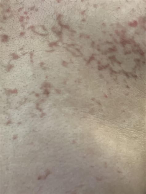 Rash Protocol Update Kinda Long Rcandida