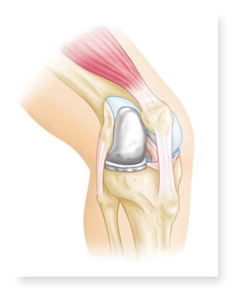 Partial Knee Replacement Surgery Dr Rahul Puri