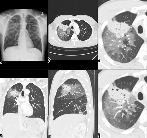 311lu Staph Aureus Cavitating Pneumonia Following Influenza Infection