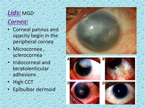 Congenital Glaucoma Part2 Developmental Glaucoma Pptx