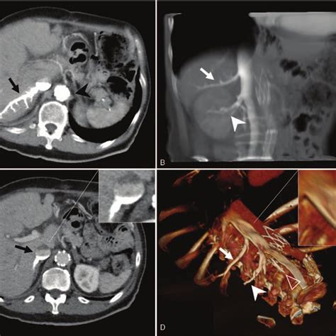 Dependent Venous Contrast Pooling And Layering Strong Enhancement Of
