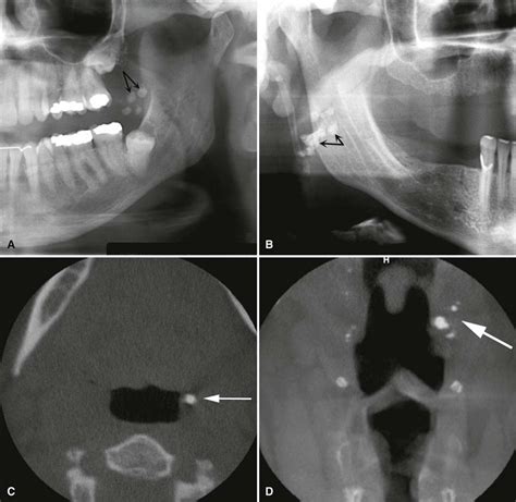 Calcification Dental X Ray At Joan Ruhl Blog