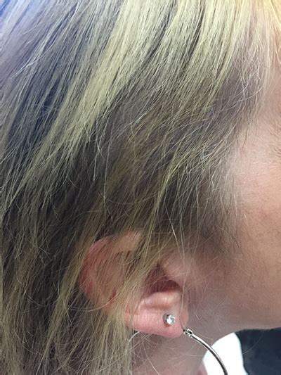 Prp With Acell Injection Therapy