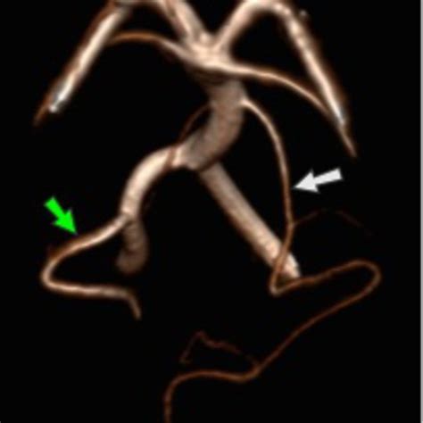 Mip Cta Showing Hypoplasia Of The Right Pcom Arrow Notice The Download Scientific Diagram