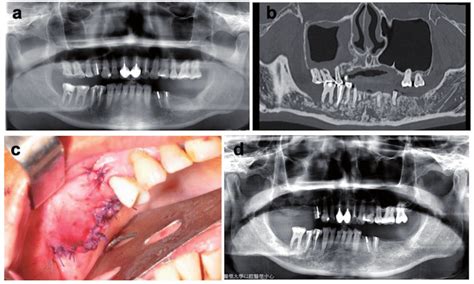 First Debridement Teeth 15 To 17 A Pre Radiation Panoramic