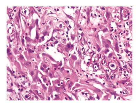 Epithelioid Cells Have Large And Big Regular Nuclei See The Presence
