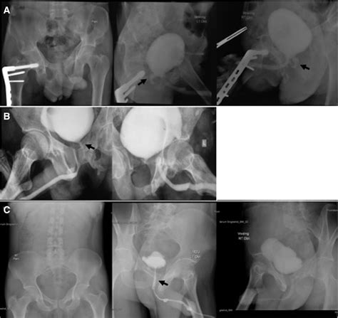 ‘poles Apart Presentation Diagnosis And Management Of Iatrogenic