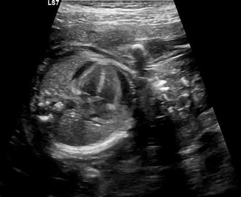Pericardial Fluid Ultrasound