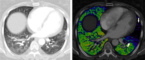 Rapid Treatment For High Risk Pulmonary Embolism
