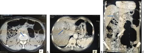 Abdominal Scan A Lower Common Bile Lithiasis Measuring 12 × 8 Mm Blue
