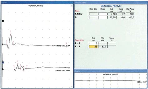 Left Deep Peroneal Nerve Conduction Block Download Scientific Diagram
