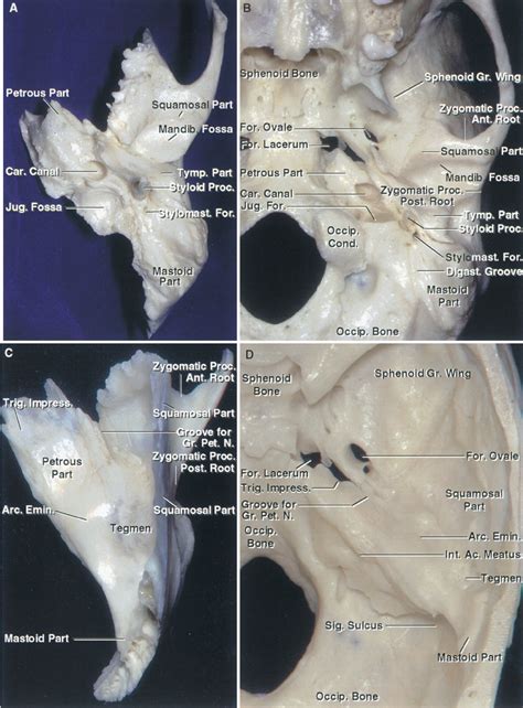 Temporal Bone Neuroanatomy The Neurosurgical Atlas