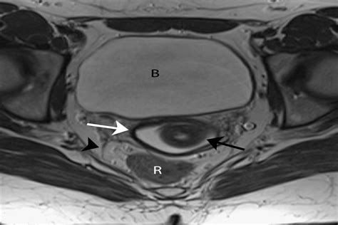 Imaging Of Cervical Pathology Topics In Magnetic Resonance Imaging