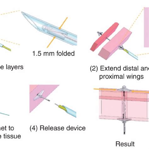 Tissue Approximation Device Deployment Sequence Download Scientific