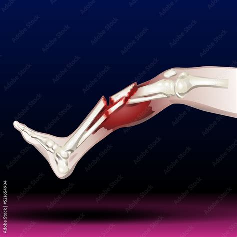 Leg Bone Fracture Illustration Stock Illustration Adobe Stock