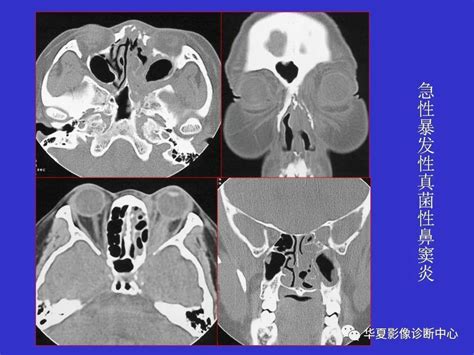 带你了解 真菌性鼻窦炎 Medscicn