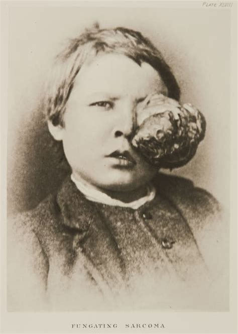 Plate Xlviii Fungating Sarcoma The Art Of The Photogravure