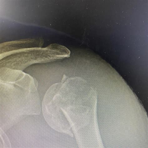 Lenin Ballesteros Lenin Ballesteros Artroscopia • Instagram Photos And Videos