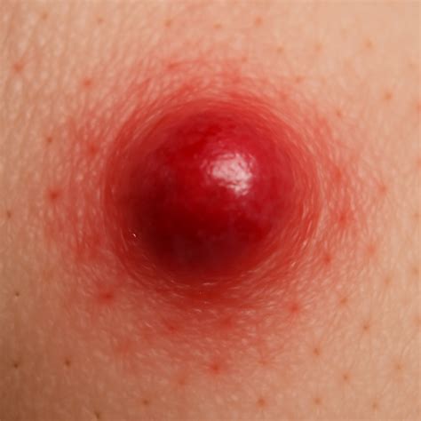 Papule Vs Nodule Difference And Comparison