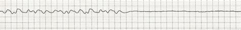 Ventricular Fibrillation Vf Ecg
