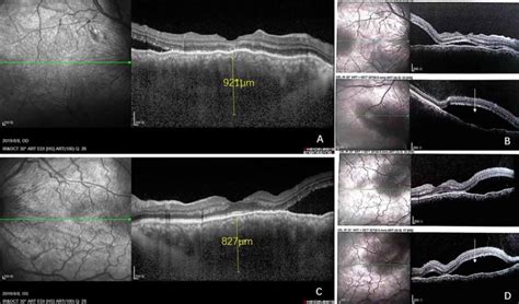 Optical Coherence Tomography Oct Showed Neuroepithelial Detachment