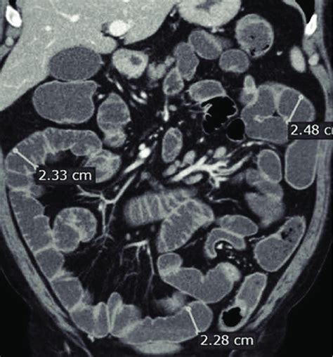 A 24 Year Old Male Patient With Normal Computed Tomography Ct