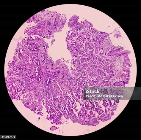 Microscopic Image Of Stomach Body Hyperplastic Polyp Show Gastric