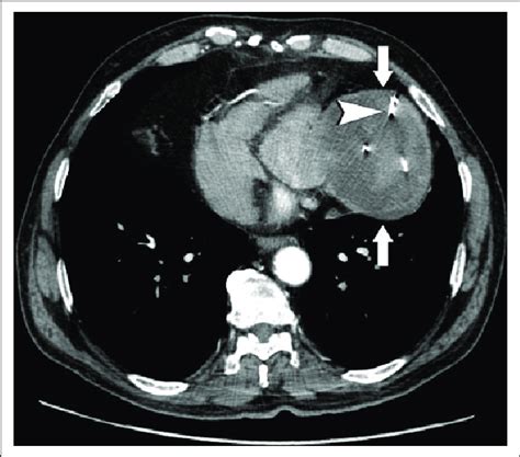 Metallic Strings In Fluid Density Mass Are Seen In Thorax Ct And