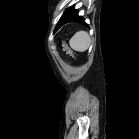 Acute Cholecystitis And Incidental Left Sided Ivc Radiopaedia 49352