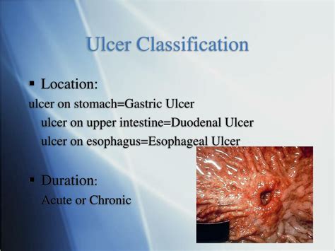 Ppt Nur 120 Peptic Ulcer Disease Powerpoint Presentation Free Download Id 6693722