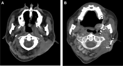 Metastasis Of Nasopharyngeal Carcinoma Notes A Lymph Node