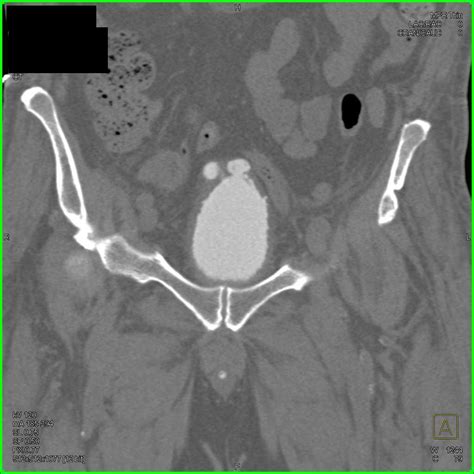 Bladder Diverticuli Genitourinary Radiology Case Studies Ctisus Ct