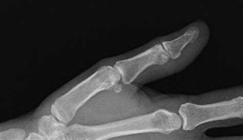 Trigger Thumb Hand Surgery Resource
