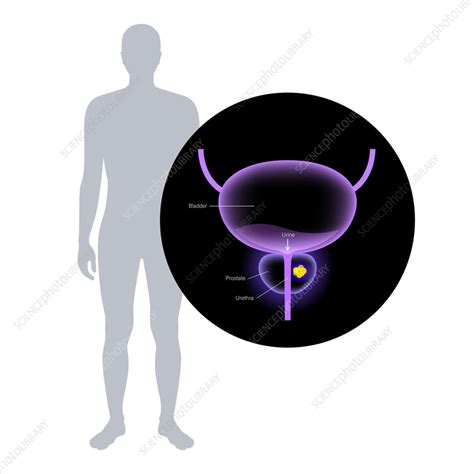 Prostate Cancer Illustration Stock Image F0363668 Science Photo