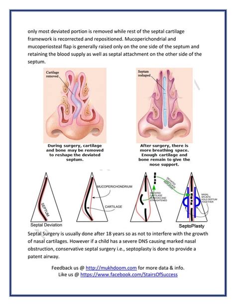 Dns Deviated Nasal Septum