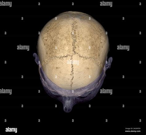 Skull Sutures Ct Anatomy