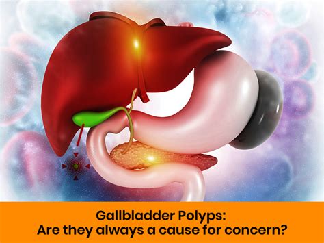 Gallbladder Polyps Are They Always A Cause For Concern