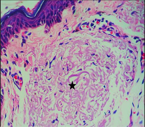 “degeneration” In Dermatopathology Indian Journal Of Dermatology