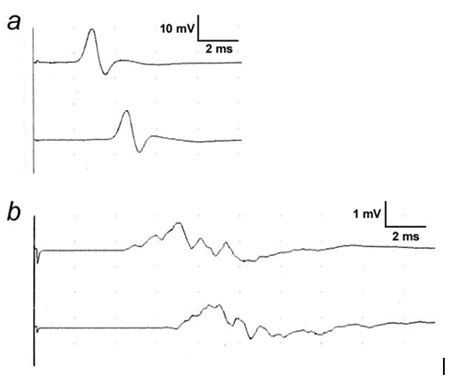 Nerve Conduction Abnormalities In Experimental Demyelinating Polyneuropathy Learn Science At