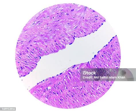 Photomicrograph Prepatellar Region Histology Showing Bursitis Acute Or