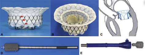 Transapical Implantation Of The Intrepid Device Case Planning And