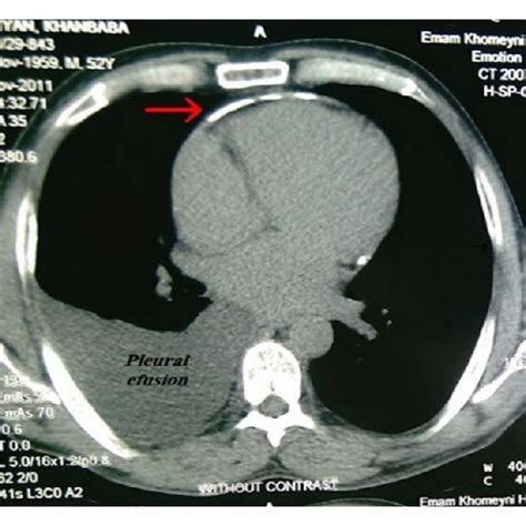 Echocardiography Showing Septal Bouncing A Dilation Of Ivc B