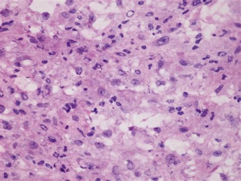 4 Angiomyolipomas Contain Occasional Cells With Enlarged Nuclei And