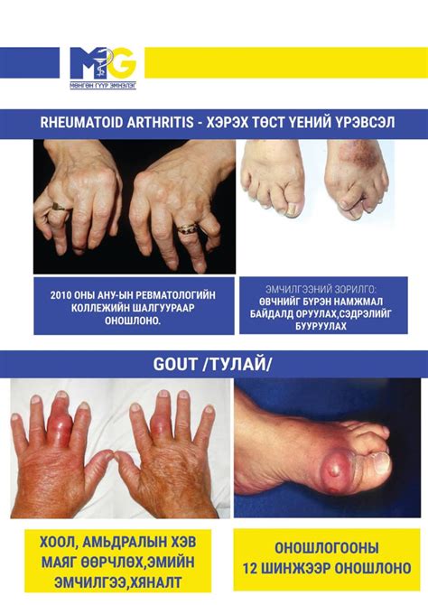 Хэрэх өвчин